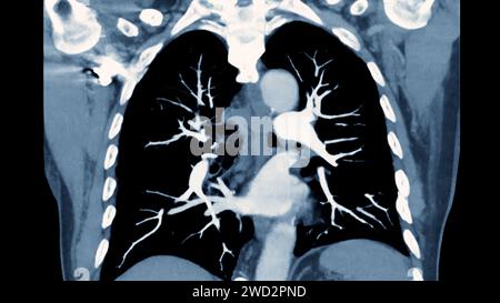 CTPA or CTA pulmonary artery .This imaging technique offers a clear ...