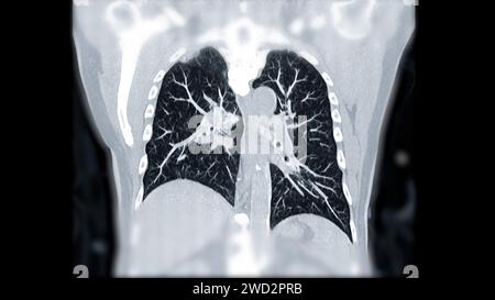 CTPA or CTA pulmonary artery .This imaging technique offers a clear ...