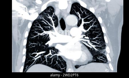 CTPA or CTA pulmonary artery .This imaging technique offers a clear ...