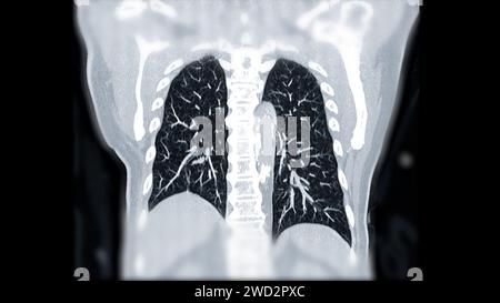 CTPA or CTA pulmonary artery .This imaging technique offers a clear ...