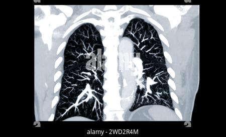 CTPA or CTA pulmonary artery .This imaging technique offers a clear ...