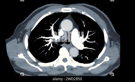 CTPA or CTA pulmonary artery .This imaging technique offers a clear ...