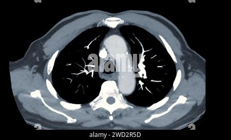 CTPA or CTA pulmonary artery .This imaging technique offers a clear ...