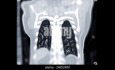 CTPA or CTA pulmonary artery .This imaging technique offers a clear ...
