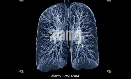 CT Chest or Lung 3d rendering image showing Trachea and lung in ...