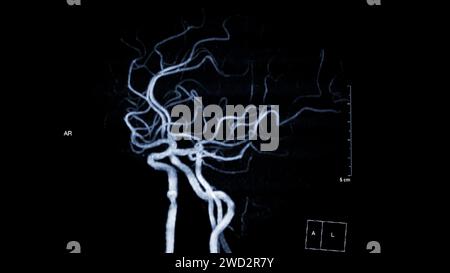 MRA Brain , This imaging technique provides clear visuals of the brain ...