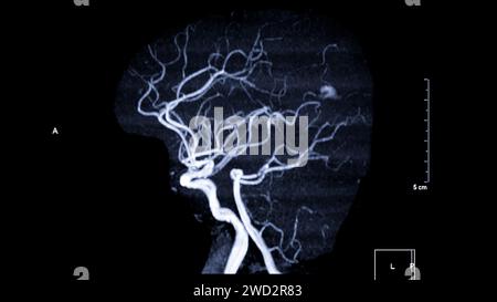 MRA Brain , This imaging technique provides clear visuals of the brain ...