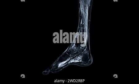 MRI FOOT scan Sagittal view T2 Fat suppression technique for diagnostic ...