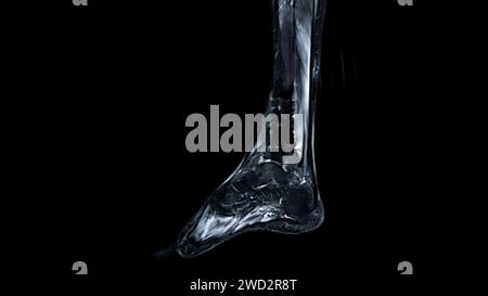 MRI FOOT scan Sagittal view T2 Fat suppression technique for diagnostic ...