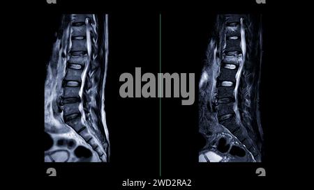 MRI L-S spine or lumbar spine Sagittal view for diagnosis spinal cord ...