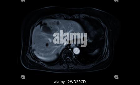 MRI of the upper abdomen axial view is a non-invasive imaging technique ...