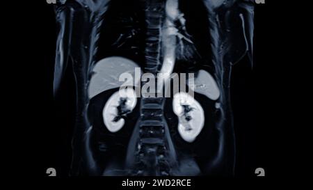 MRI of the upper abdomen coronal view is a non-invasive imaging ...