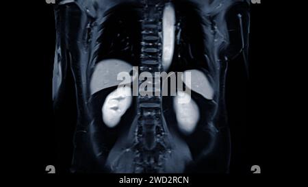 MRI of the upper abdomen coronal view is a non-invasive imaging ...