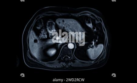 MRI of the upper abdomen axial view is a non-invasive imaging technique ...