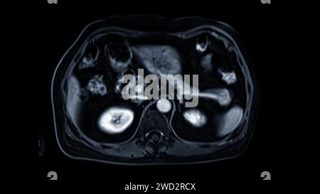 MRI of the upper abdomen axial view is a non-invasive imaging technique ...