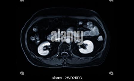 MRI of the upper abdomen axial view is a non-invasive imaging technique ...