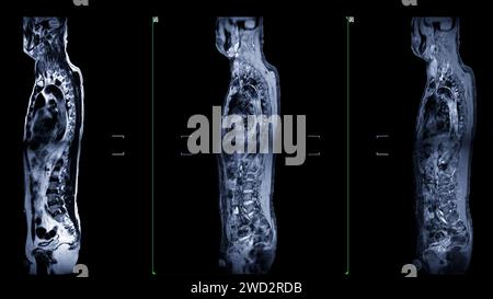 An MRI of the whole spine image is a comprehensive visual ...