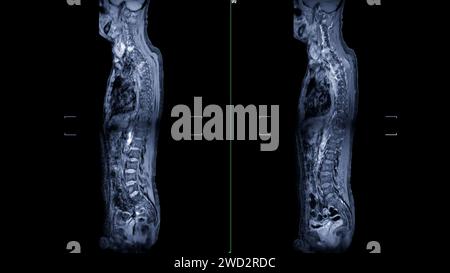 An MRI of the whole spine image is a comprehensive visual representation produced through ...