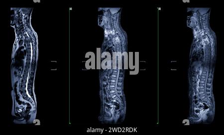 An MRI of the whole spine image is a comprehensive visual ...