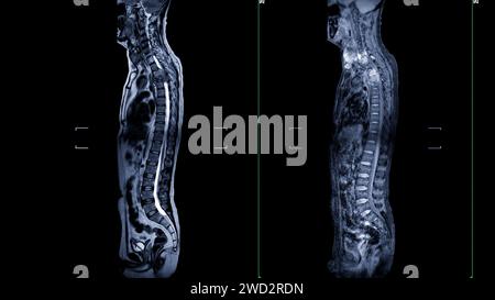 An MRI of the whole spine image is a comprehensive visual representation produced through ...