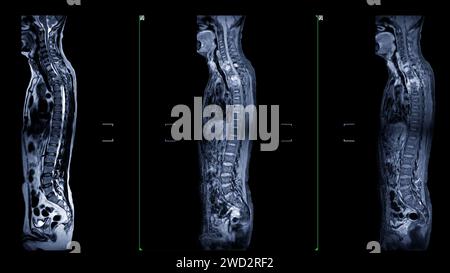 An MRI of the whole spine image is a comprehensive visual representation produced through ...