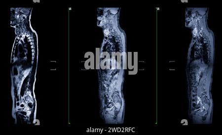 An MRI of the whole spine image is a comprehensive visual ...