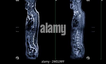 An MRI of the whole spine image is a comprehensive visual ...