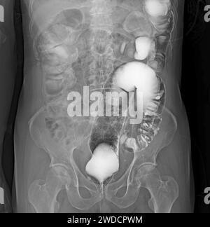 Colon diverticula, X-ray Stock Photo - Alamy