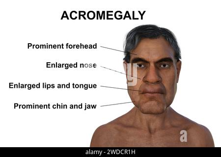 Acromegaly in a man compared to healthy man, illustration Stock Photo ...