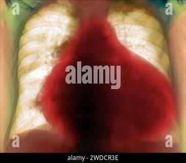 Enlarged heart. Chest X-ray of the enlarged heart (cardiomegaly, blue ...