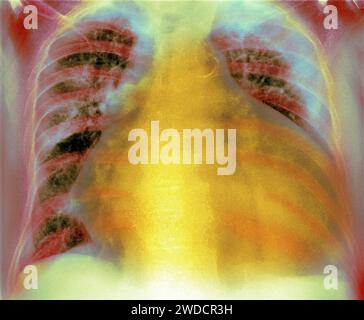 Cardiomyopathy, chest X-ray Stock Photo - Alamy