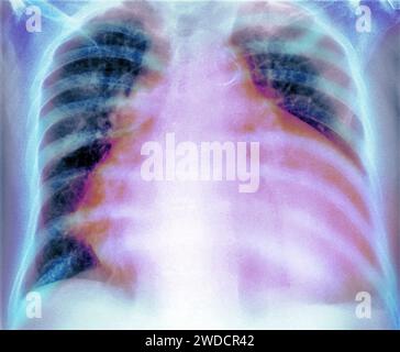 Cardiomyopathy, chest X-ray Stock Photo - Alamy