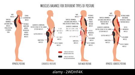 Posture disorders infographics. Flat back posture. The side view shows characteristic decrease ...