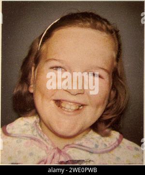 Albrights Hereditary Osteodystrophy 2 Stock Photo - Alamy