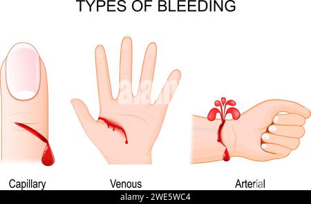 vector illustration of a Arterial and venous bleeding Stock Vector ...