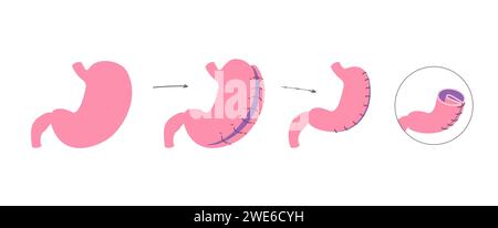 Gastric plication infographics. The explanation picture of stomach ...