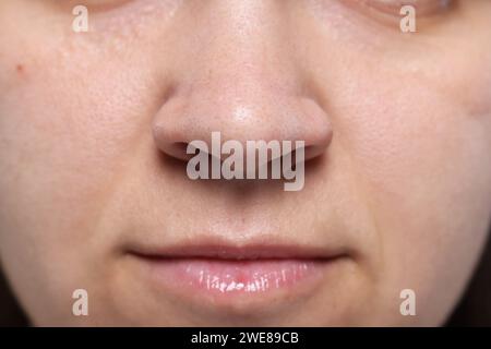 Closeup view of woman with comedones on her nose Stock Photo - Alamy