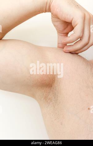 Armpit rash. Unrecognisable man shows irritation on the sensitive skin ...