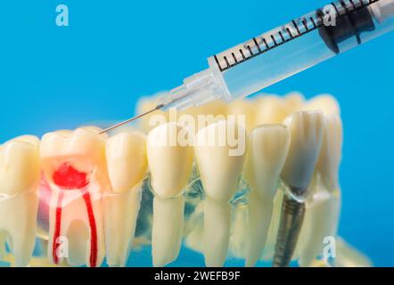 Injection of an anesthetic drug into the gum of a diseased tooth for ...