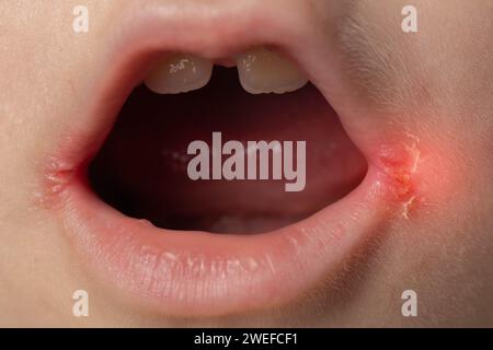 slit-like impetigo in a little girl in the corners of her mouth. Skin ...