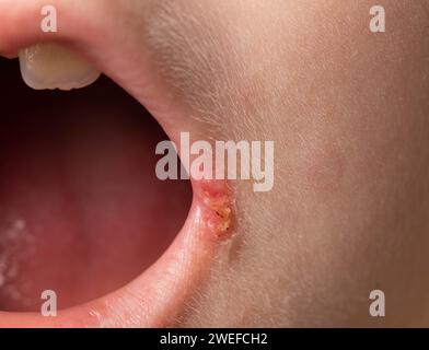 slit-like impetigo in a little girl in the corners of her mouth. Skin ...