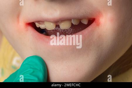 Pain and itching in the corners of the lips of a girl's mouth. Seizures ...