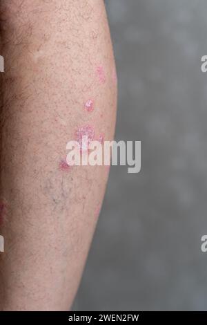 Psoriasis Vulgaris, skin patches are typically red, itchy, and scaly ...