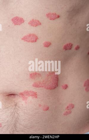 Psoriasis Vulgaris, skin patches are typically red, itchy, and scaly ...