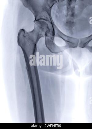 An X-ray reveals both hip joints in normal study Stock Photo - Alamy