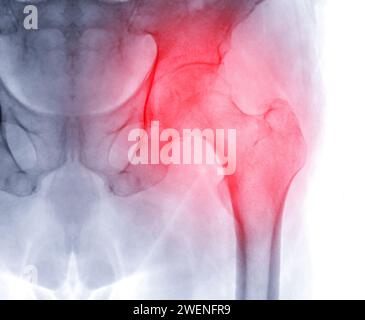 An X-ray reveals both hip joints in normal study Stock Photo - Alamy