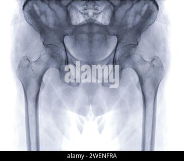 An X-ray reveals both hip joints in normal study Stock Photo - Alamy
