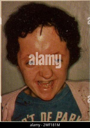 Apert Syndrome 6 Stock Photo - Alamy