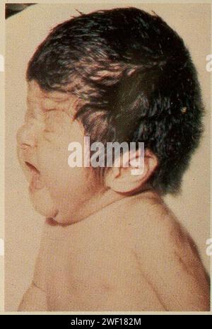 Apert Syndrome 3 Stock Photo - Alamy