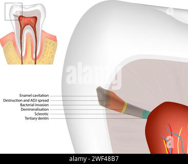 Illustration of progress of tooth decay Stock Vector Image & Art - Alamy